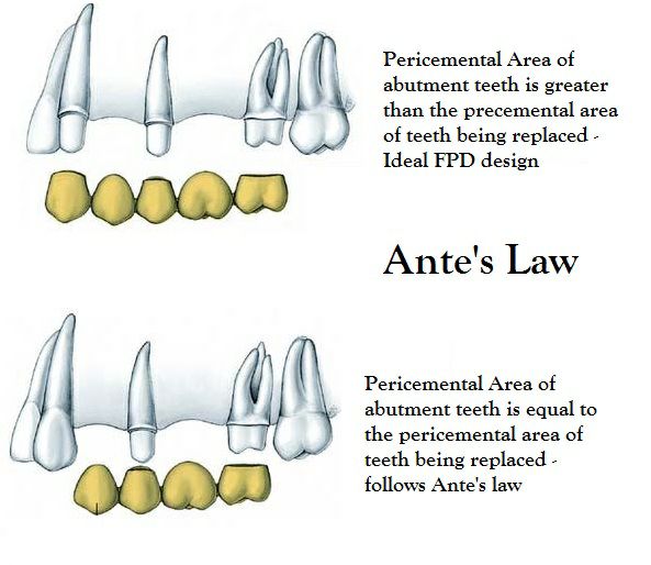 Ante’s Law in Fixed Dental Prosthodontics | Clinical Guide